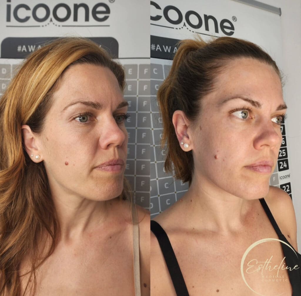 ICOONE Laser | Estheline